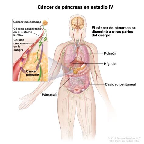 Síntomas Del Cáncer De Páncreas Se Pueden Detectar A Tiempo El