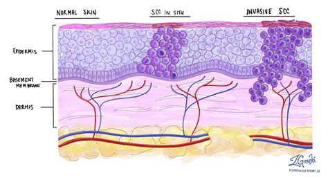 I Squamous Cell Carcinoma Endaweni Yesikhumba Mypathologyreportca