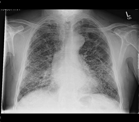 Lung Fibrosis Scar Treatment In Homeopathy