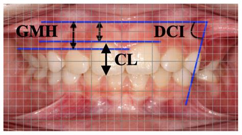 What Is Gingival Margin At Marcellus Meyers Blog
