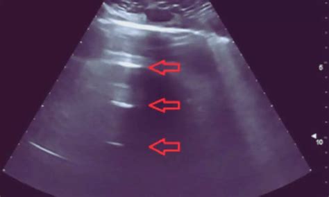 Lung Ultrasound Score Easy And Effective Bedside Tool For Assessing