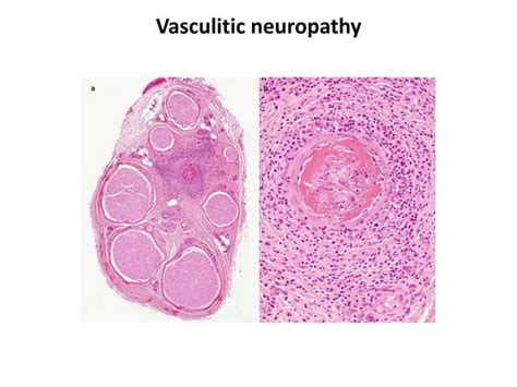 Peripheral Nerve Biopsy Pptx