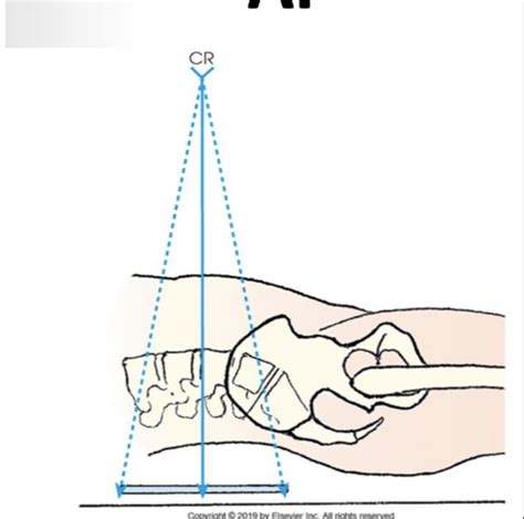 Positioning Lumbar Spine Flashcards Quizlet