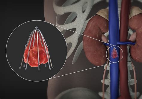 Ivc Filters Mr Safety Questions And Answers In Mri