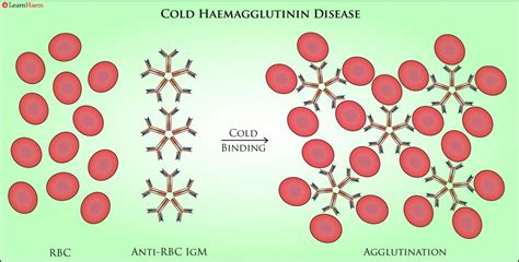 Autoimmune Haemolytic Anaemia Learnhaem Haematology Made Simple