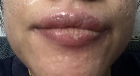 Is This Exfoliative Cheilitis Rdermatologyquestions
