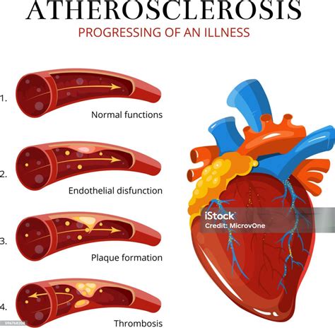 Aterosklerosis Pembentukan Gumpalan Darah Ilustrasi Medis Vektor Ilustrasi Stok Unduh Gambar