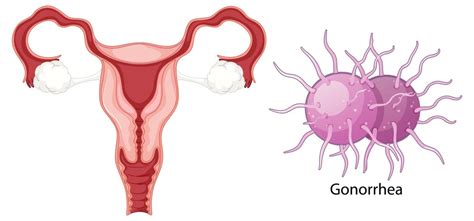 Free Vector Vaginal Infection Bacteria Concept