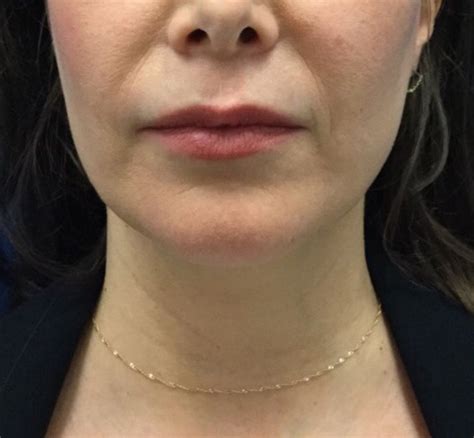 Chin And Neck Ideal Face And Body