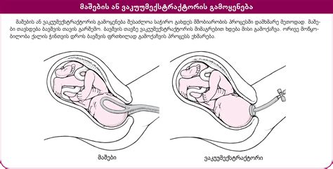 მშობიარობა და პროცედურები მკურნალი გე