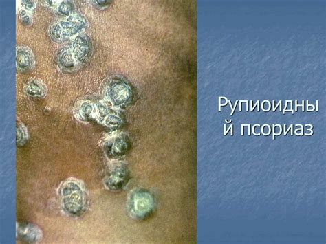 Псориаз, КПЛ - online presentation