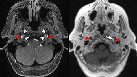Pulsatile Tinnitus Carotid Artery Dissection