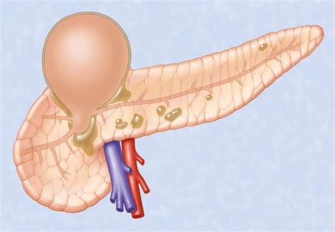 Endoscopic Treatment Of Pancreatic Disease Clinical Tree