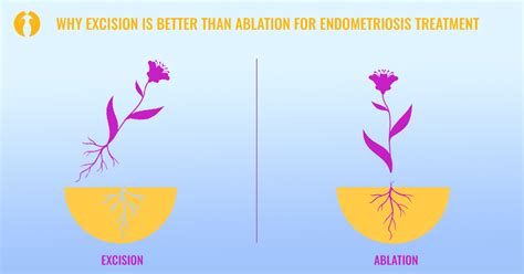 Why Excision Is Better Than Ablation For Endometriosis Treatment The