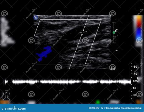Cpt Code For Venous Doppler Lower Extremity At Kurt Scott Blog