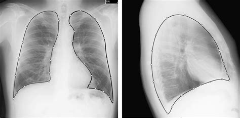 Figure From Computer Aided Diagnosis Of Emphysema In Copd Patients
