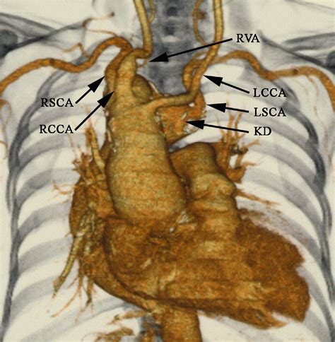 One Stage Repair For Aortic Regurgitation And Kommerell Diverticulum