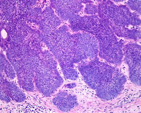 Human Skin Basal Cell Carcinoma Stock Image Image Of Cells