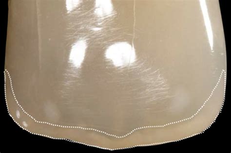 Unit 16 Class Iv Preparation And Restoration With Composite Resin Flashcards Quizlet