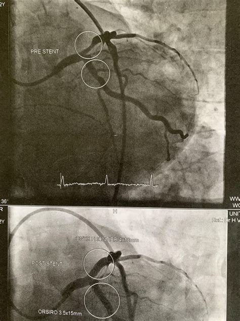 10 Months Post Stemi R Heartattack
