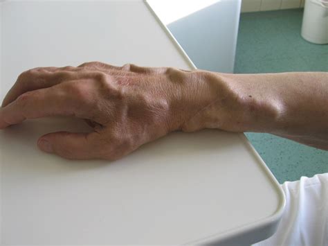 Vascular Hands
