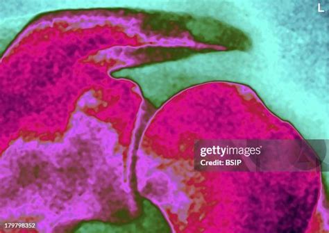 Shoulder Dislocation X Ray Photos And Premium High Res Pictures Getty Images