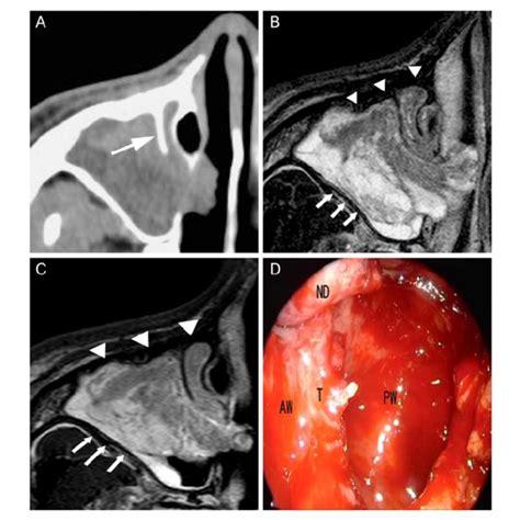 Pdf Prediction Of The Attachment Site Of Sinonasal Inverted Papillomas By Preoperative Imaging
