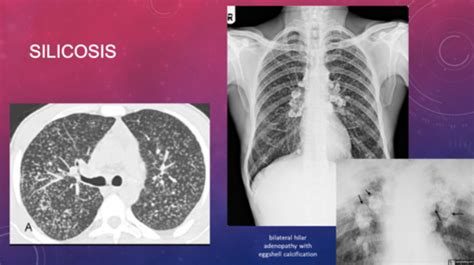 INTERSTITIAL PULM DISORDERS Flashcards Quizlet