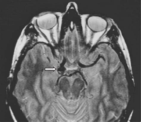 Posterior Cerebral Artery Mri My Xxx Hot Girl