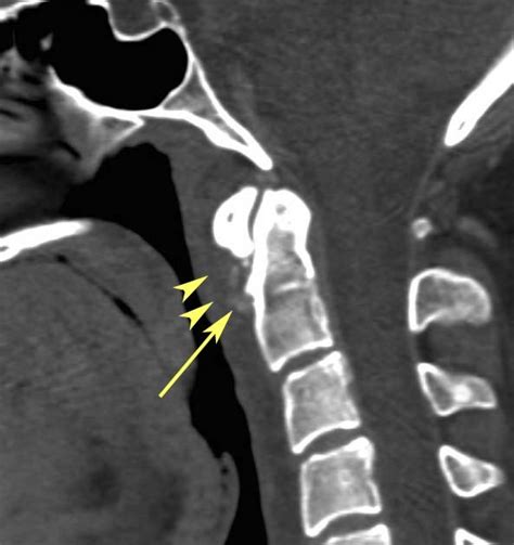 Rit Radiology Calcific Tendinitis Of The Longus Colli