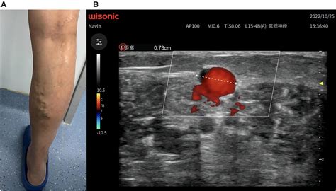 Case Report Use Of Laparoscopic Electrocoagulation Rods In Endovenous