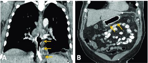 The Same Patient 9 After Retreatment With Mega Stent Sequential Ct