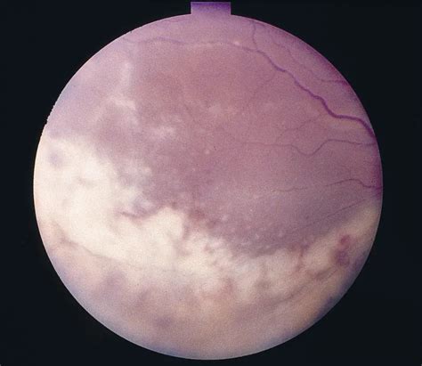 Cytomegalovirus Retinitis American Academy Of Ophthalmology