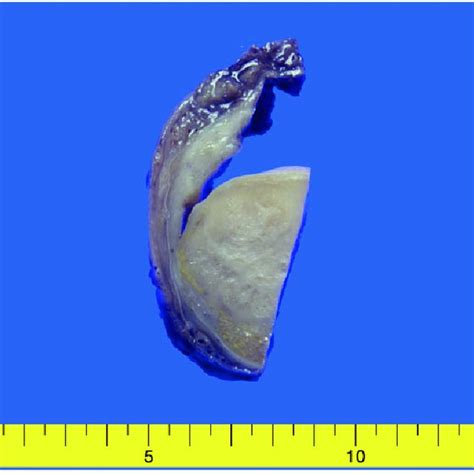 Gross Pathology Of Right Testicular Seminoma Download Scientific Diagram