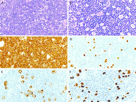 A An Excisional Biopsy Of The Axillary Lymph Node Shows A Nodal