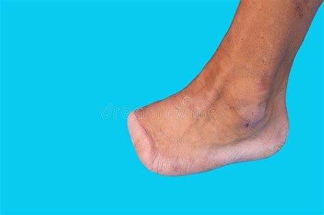 Amputation Of All Toes Of A Diabetic Man S Foot Diabetic Foot Shampoo