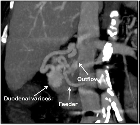 Carto For Ectopic Variceal Bleeding 70yf Cirrhosis Upper Gi