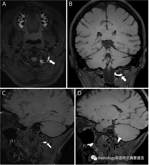 椎动脉夹层所致延髓背外侧综合征：或许不是擀面杖的错！ 搜狐大视野 搜狐新闻