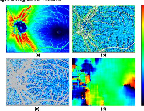 Figure 1 From Retinal Nerve Fiber Bundle Tracing And Analysis In Human Eye By Polarization