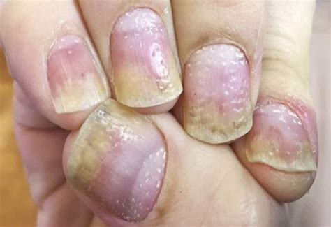 Móng Tay Bị Rỗ Do Những Nguyên Nhân Nào