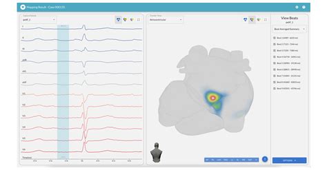 Vektor Medical Announces New Cpt Code For Novel Noninvasive Arrhythmia
