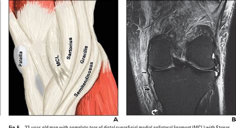 Figure 5—22 From Pes Anserinus Anatomy And Pathology Of Native And