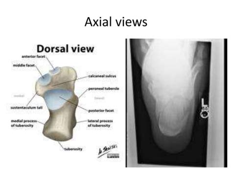 Calcaneum Radiographic Views Pptx