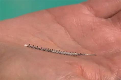 Explanation Of The Essure Procedure