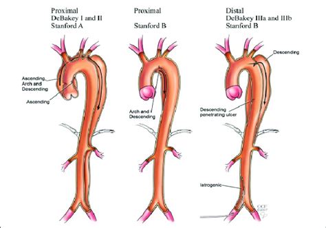 Aortic Dissection Classification From The Debakey And Stanford