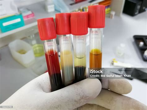 Common Types Of Blood Serum Sample Errors Hemolyzed Icteric Lipemic And