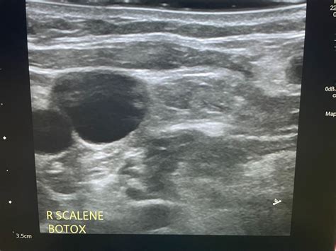 Shueh Hao Lim On Linkedin Anterior Scalene Botox Injection For