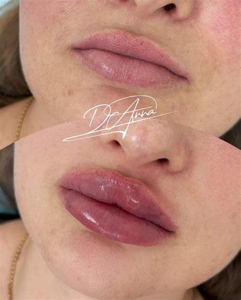 Dr Anna Dha Licensed Gp Aesthetic Doctor Drannadubai • Instagram Photos And Videos