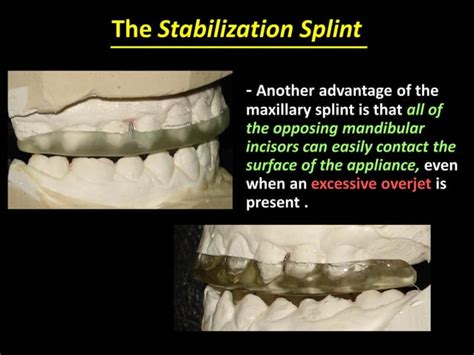 Tmds And Occlusal Splint Therapy