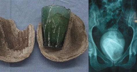Doctors Discover Tumbler Stuck In Womans Bladder For 4 Years After It